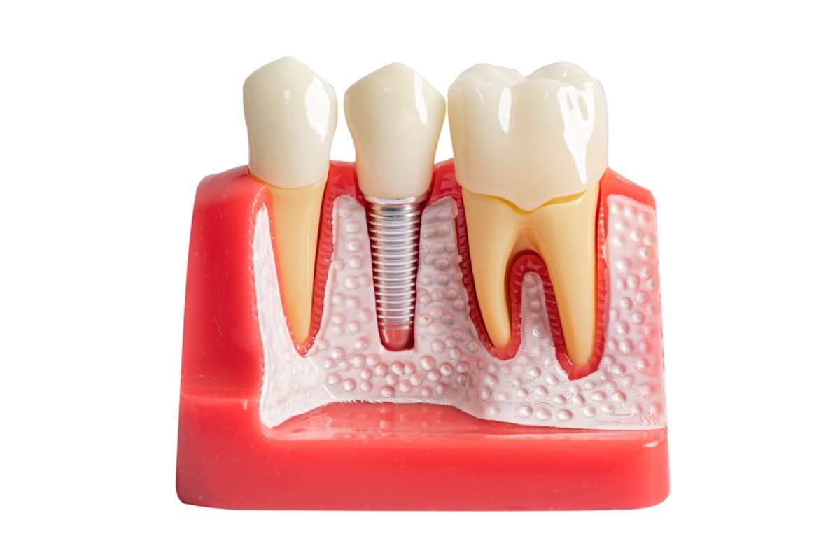 Tired of Dentures Moving? Try Dental Implants Instead